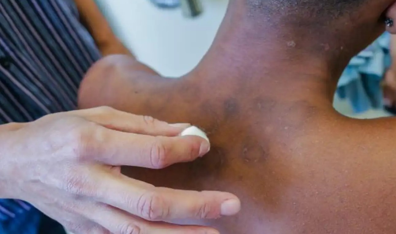 Entenda como diferenciar as manchas de dengue de outras doenças na pele ...